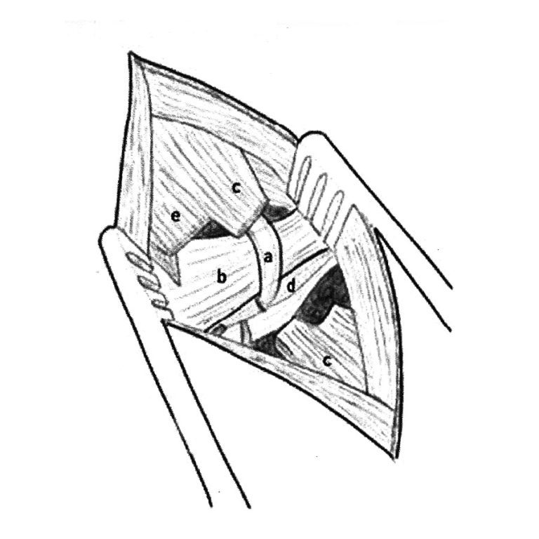 Patient-Friendly Pudendal Nerve Surgery Handout | AZCCPP