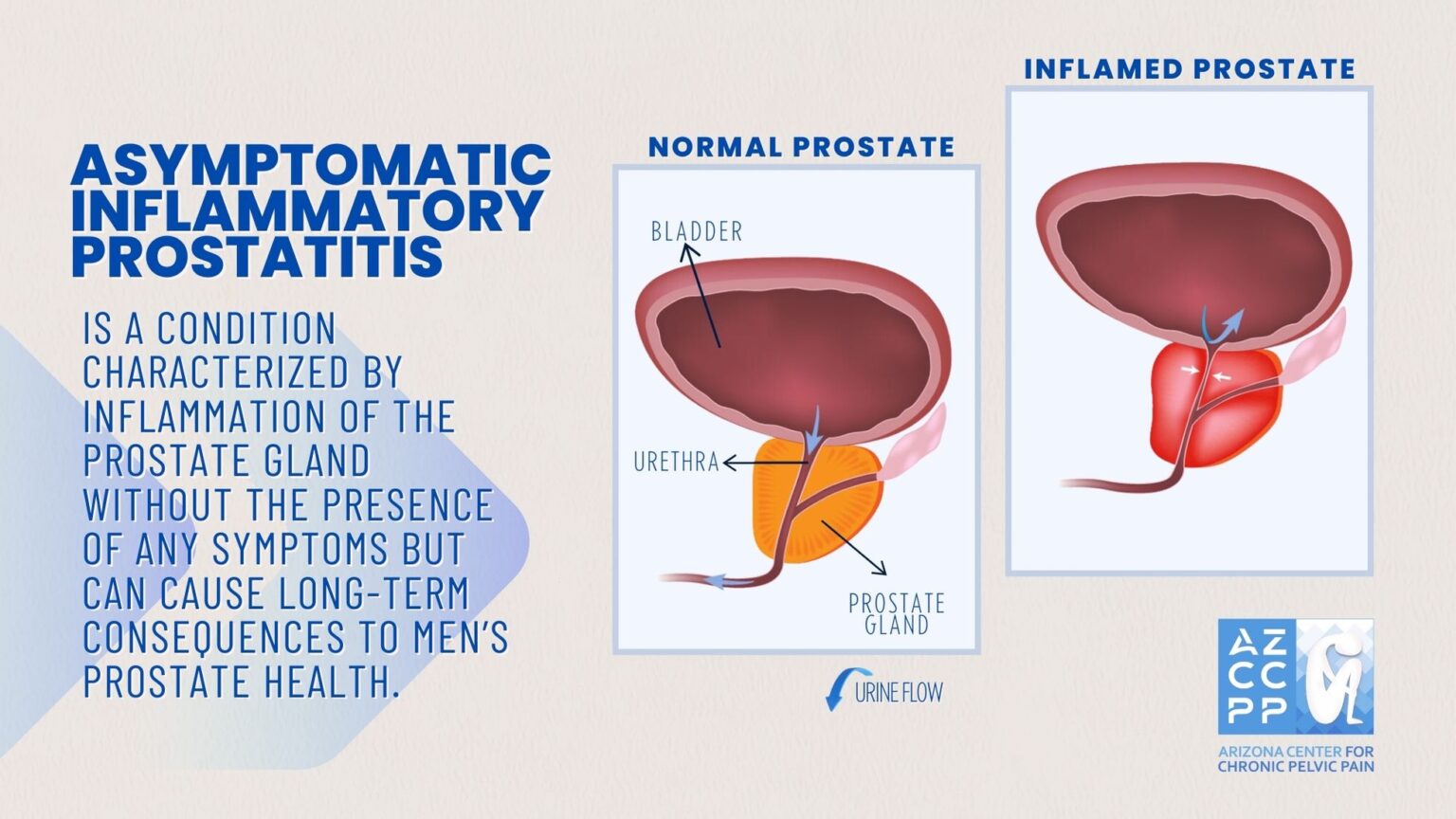 What Is Asymptomatic Inflammatory Prostatitis | AZCCPP